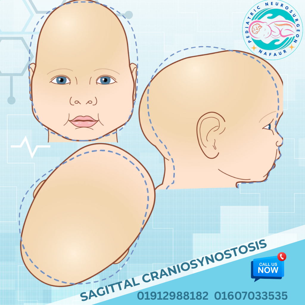 Scaphocephaly Treatment